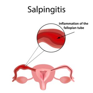 Salpingitis: qué es, tratamiento y cómo afecta a la fertilidad
